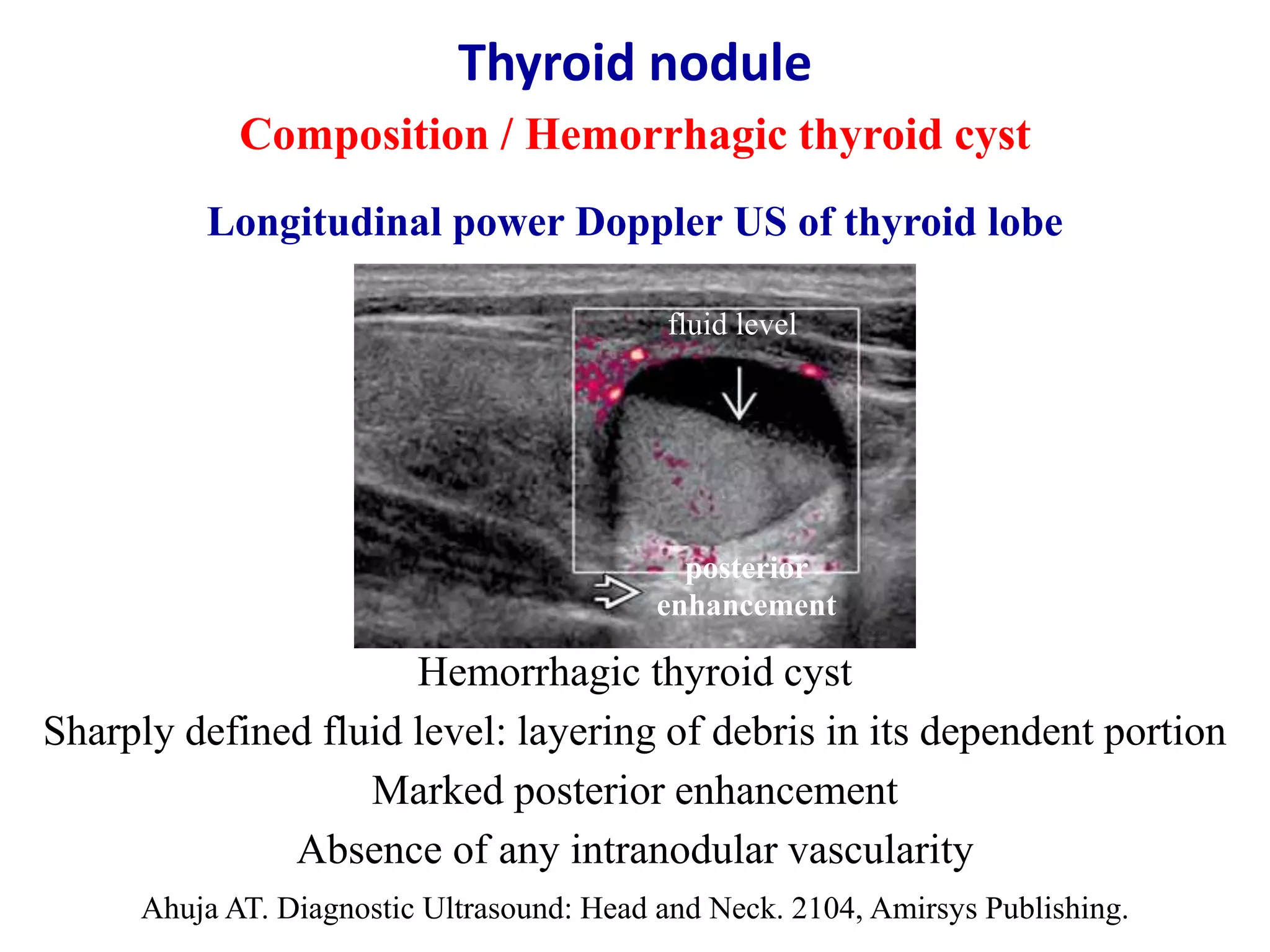 Ultrasound Of Thyroid Nodules Pptx
