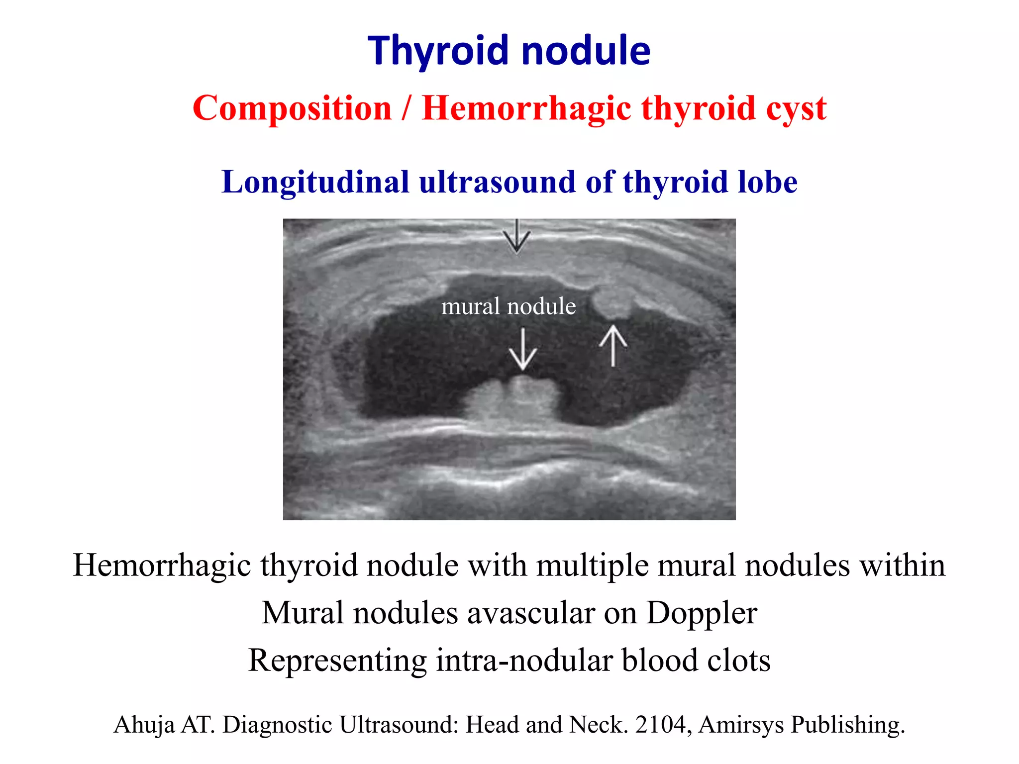 Ultrasound of thyroid nodules | PPTX