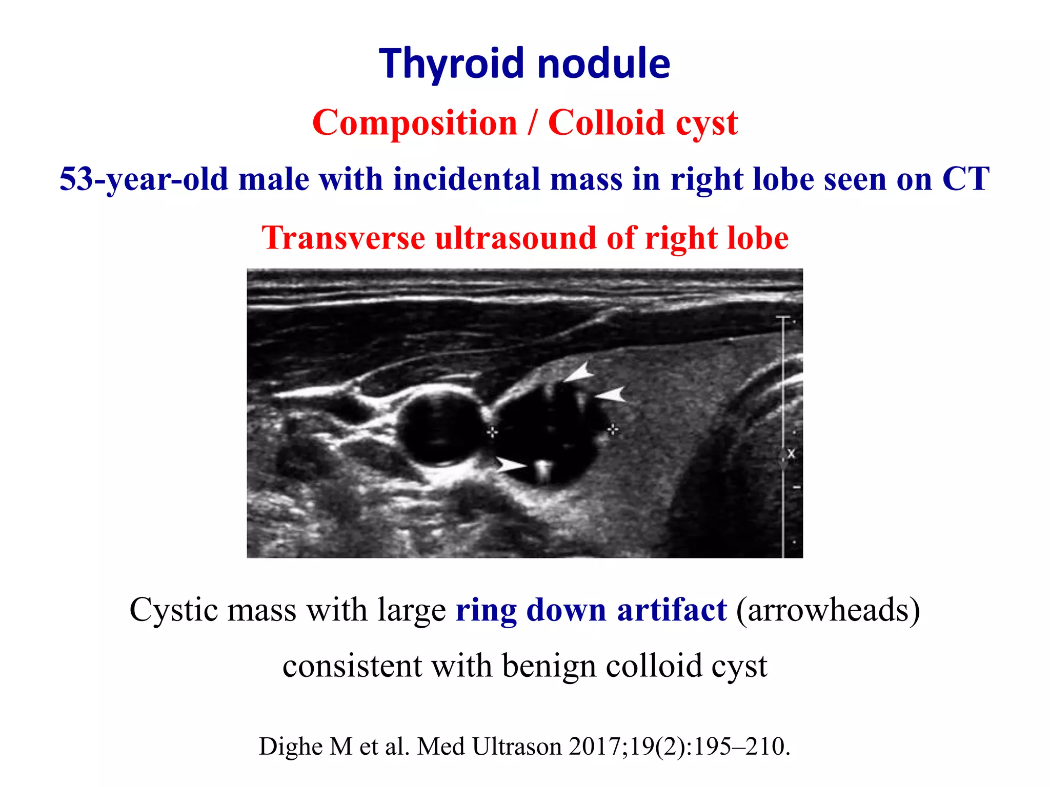Ultrasound of thyroid nodules | PPTX