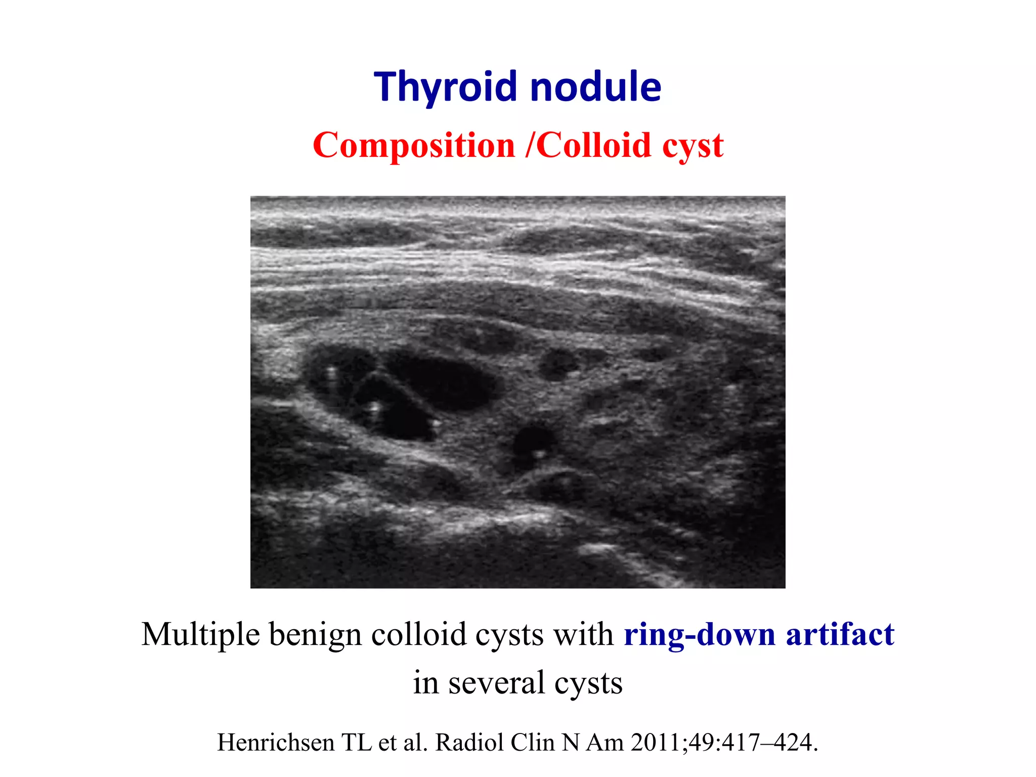 Ultrasound of thyroid nodules | PPTX