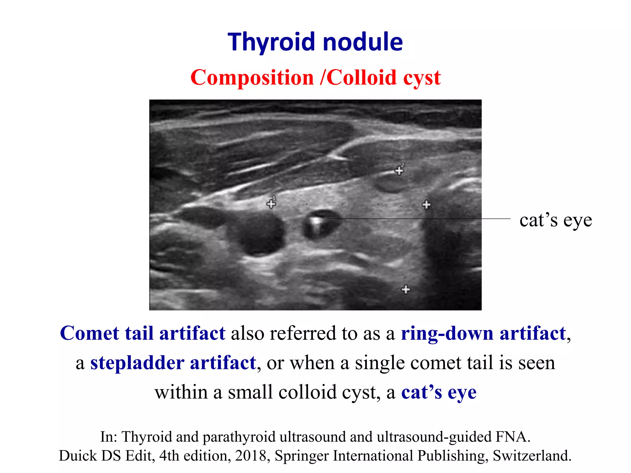 Ultrasound of thyroid nodules | PPTX