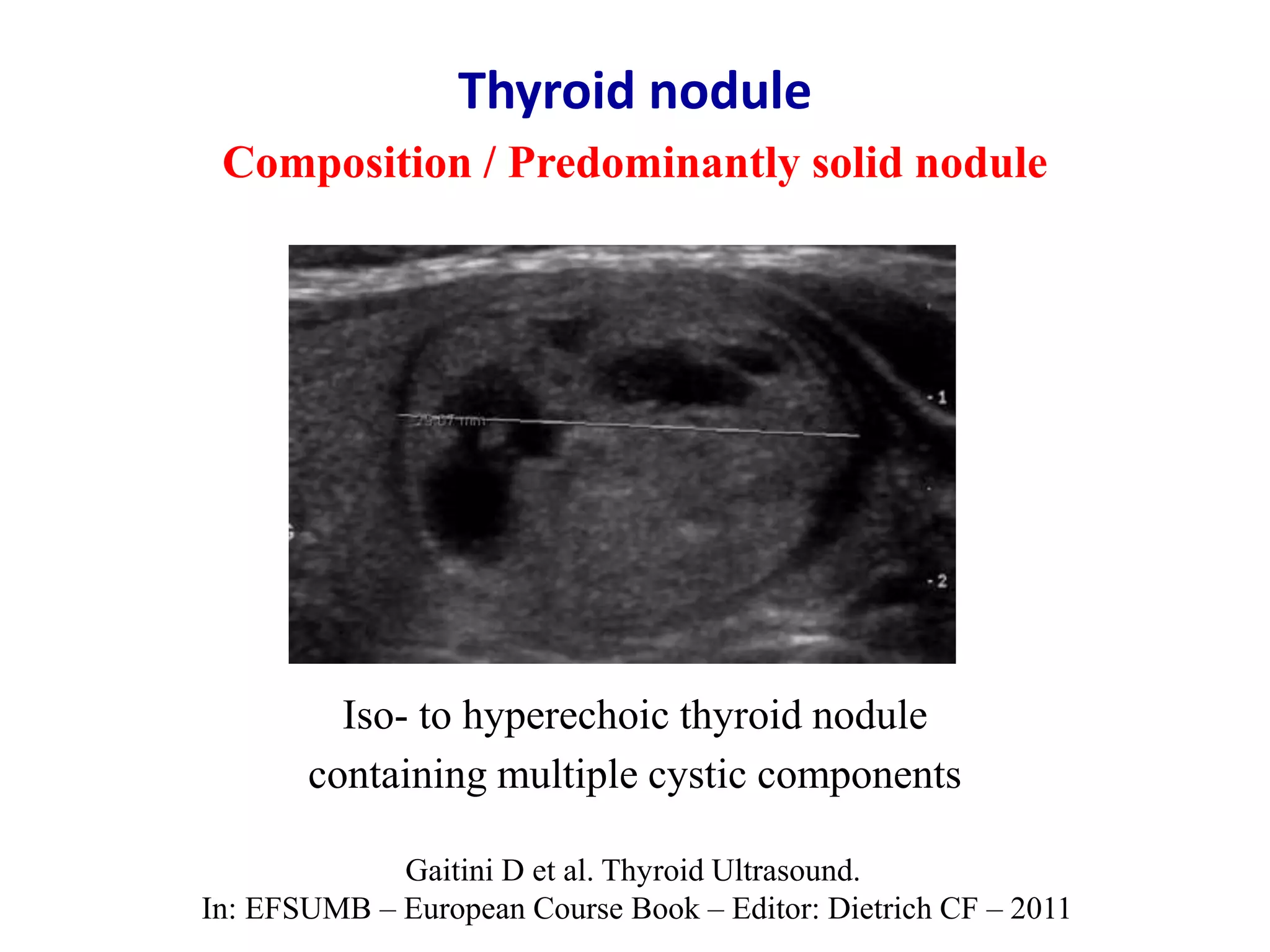 Ultrasound of thyroid nodules | PPTX