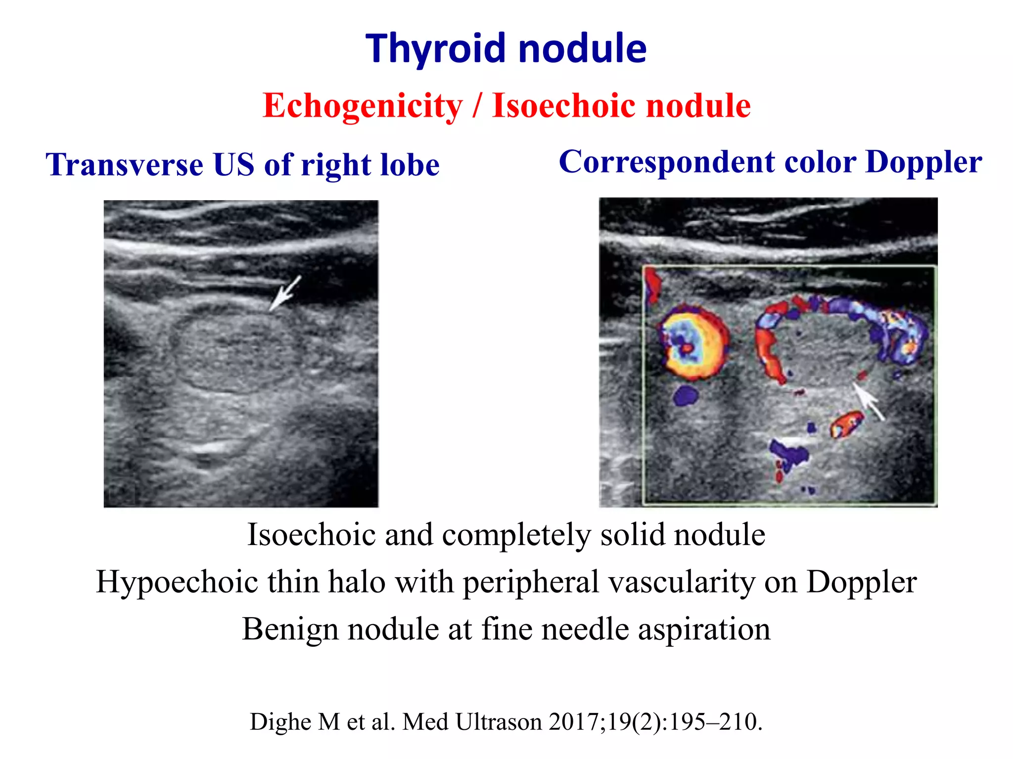 Ultrasound of thyroid nodules | PPTX