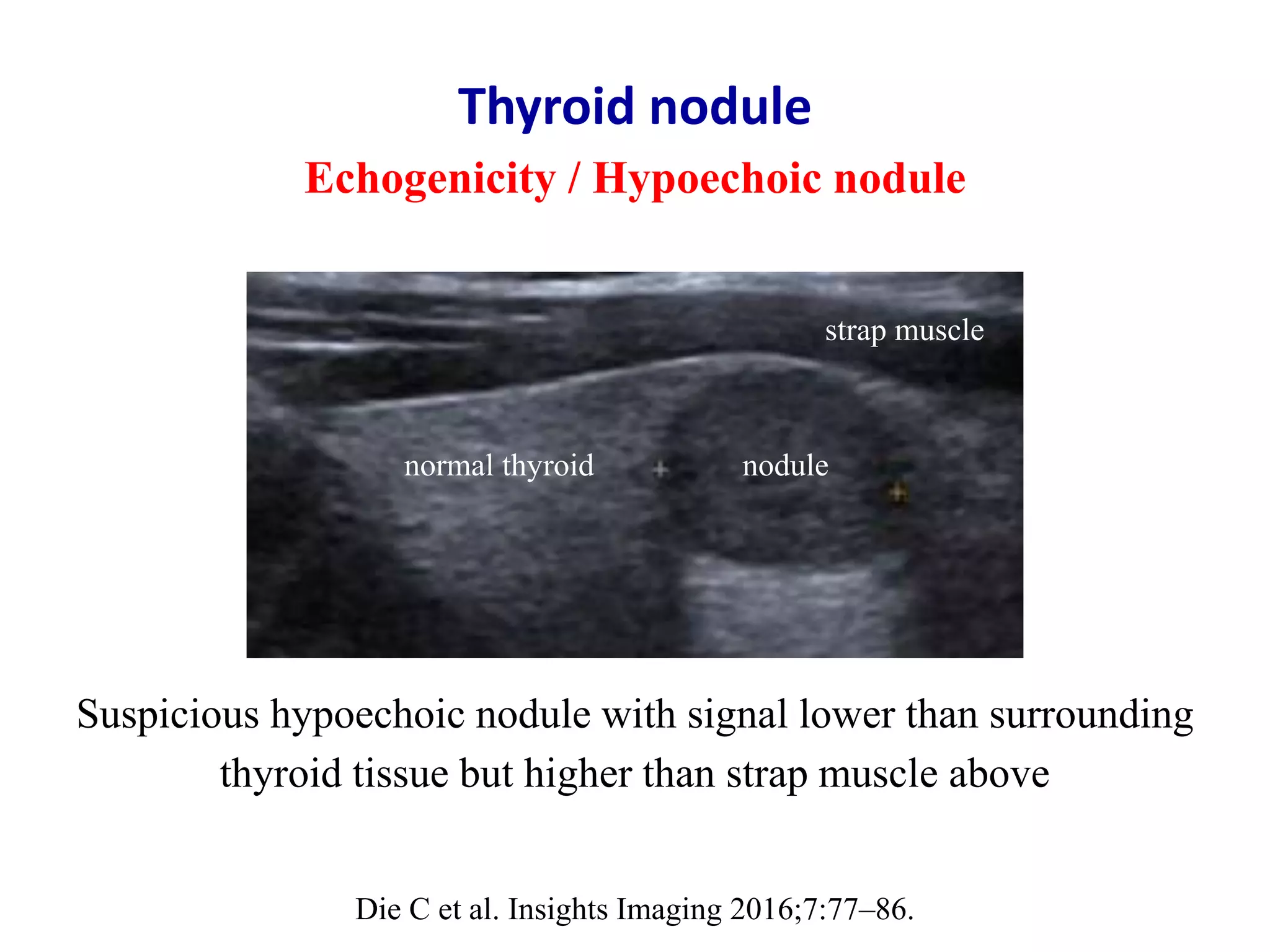 Ultrasound of thyroid nodules | PPTX