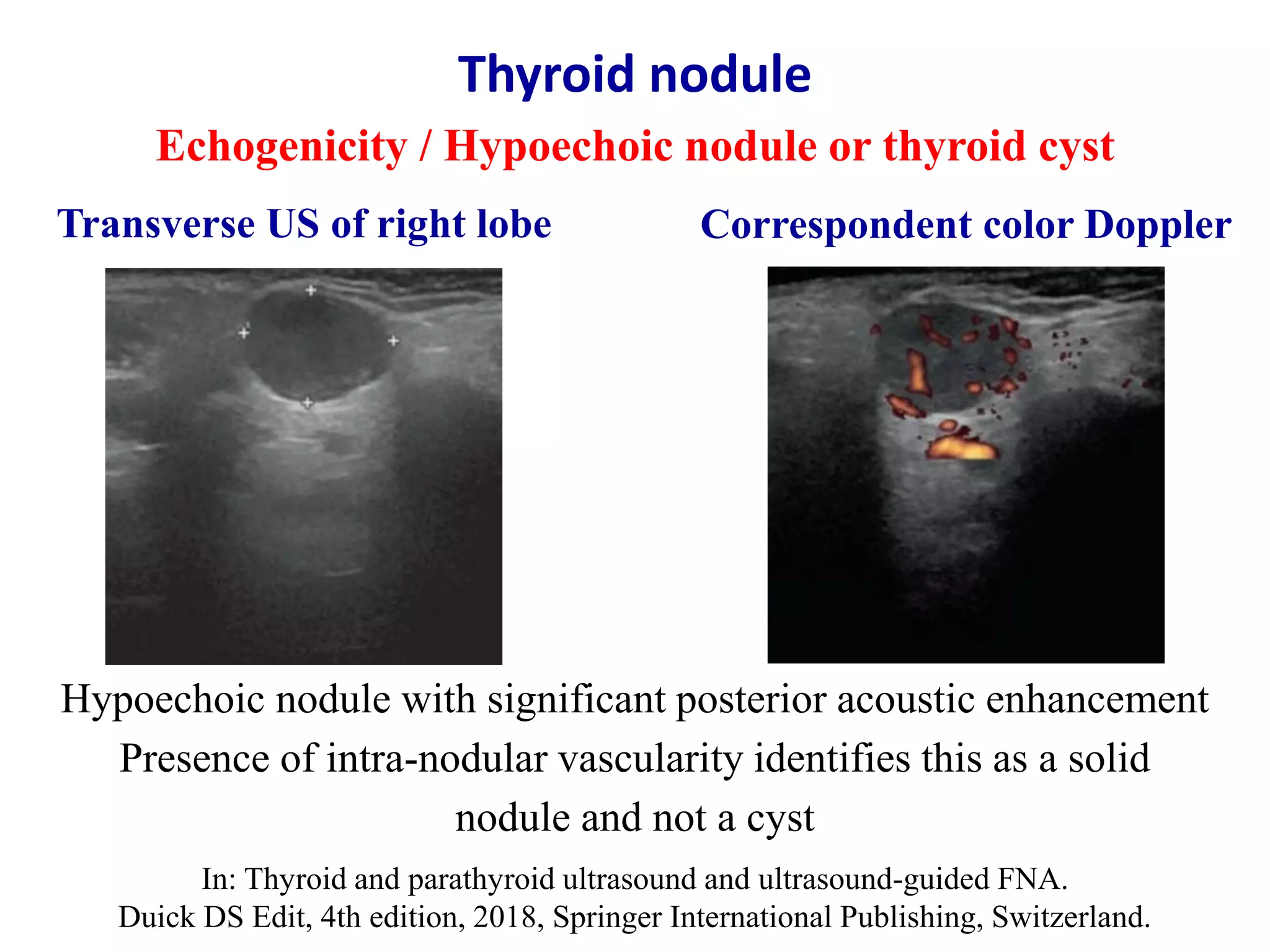 Ultrasound of thyroid nodules | PPTX