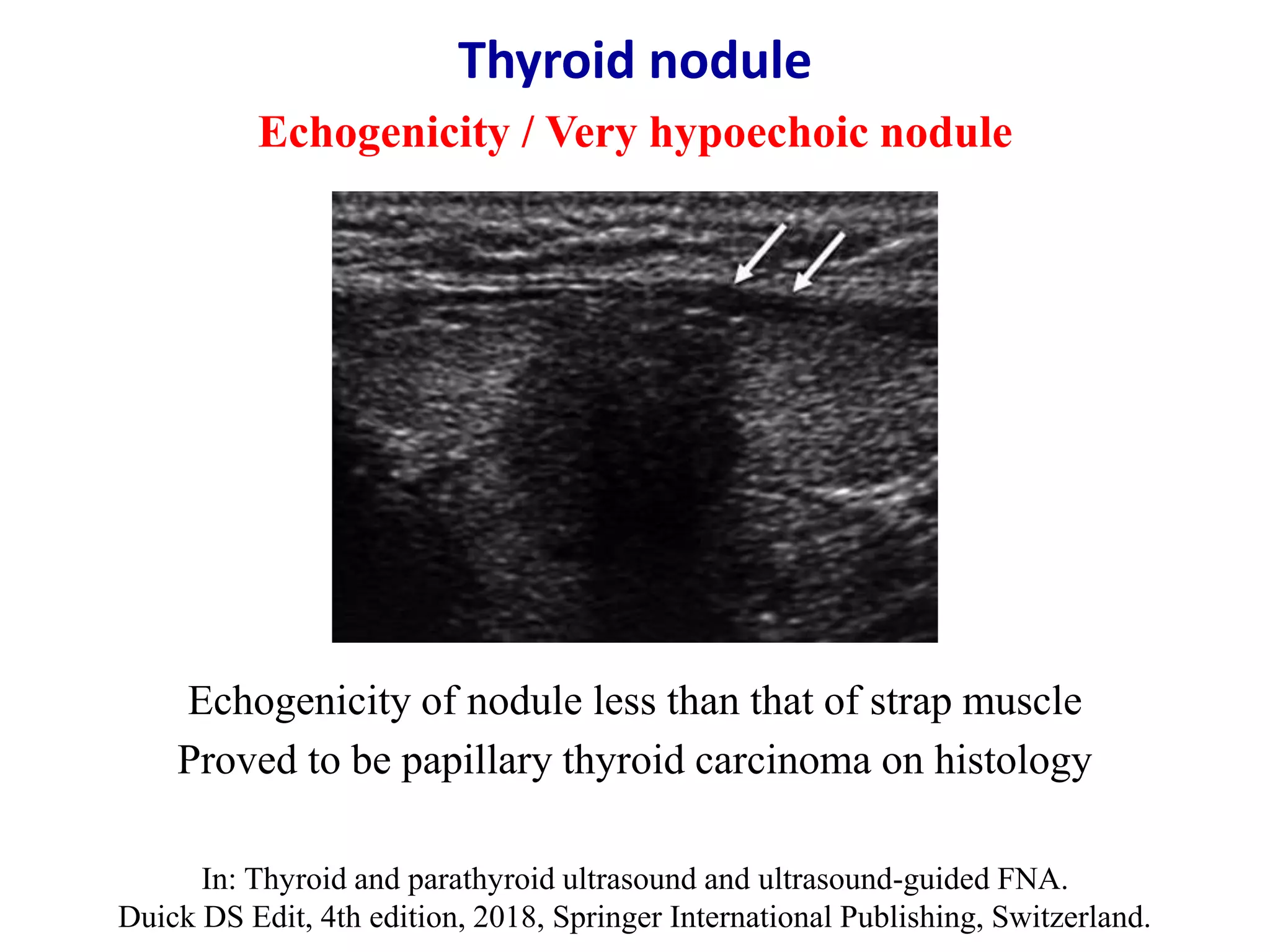 Ultrasound Of Thyroid Nodules PPTX