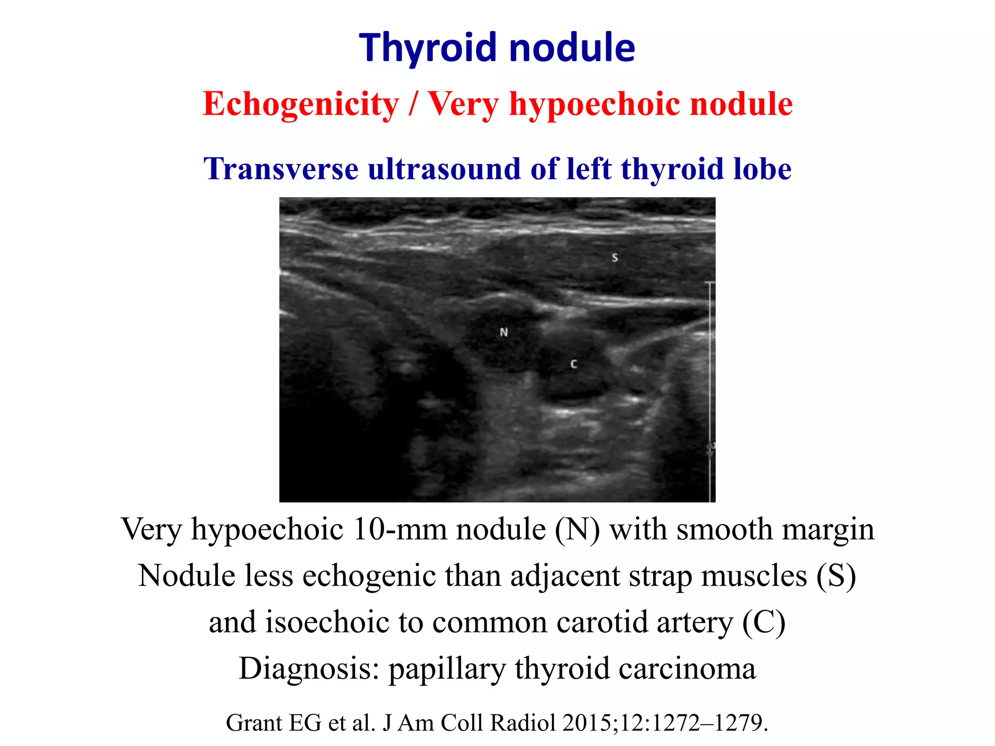 Ultrasound of thyroid nodules | PPTX