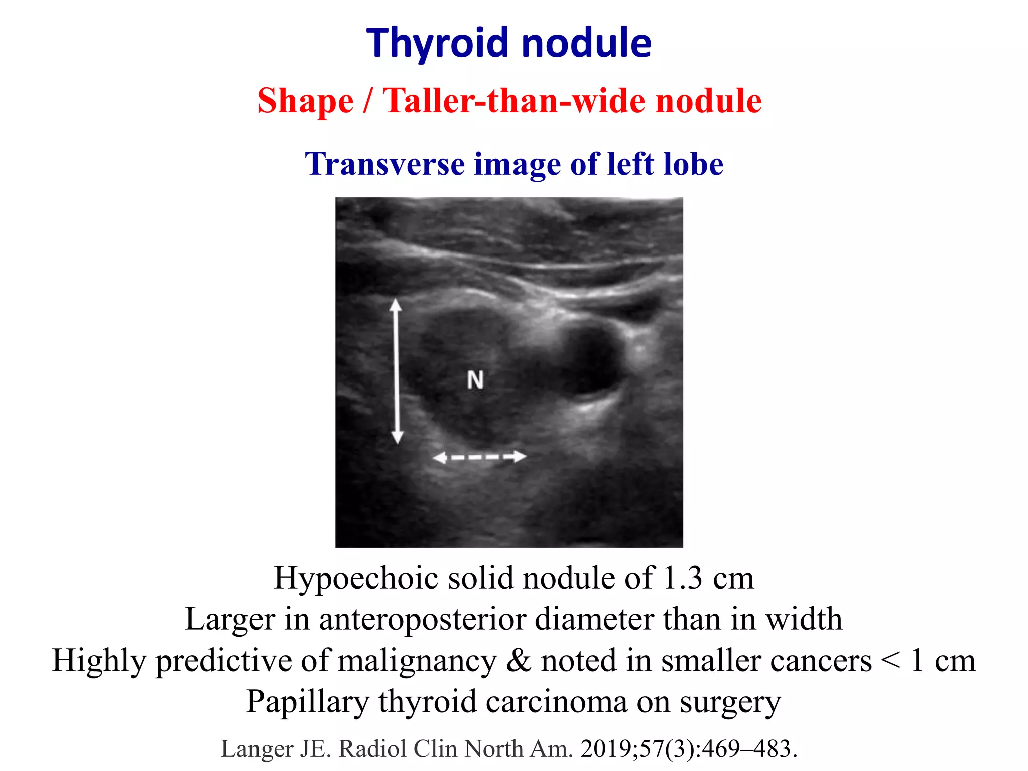 Ultrasound of thyroid nodules | PPTX