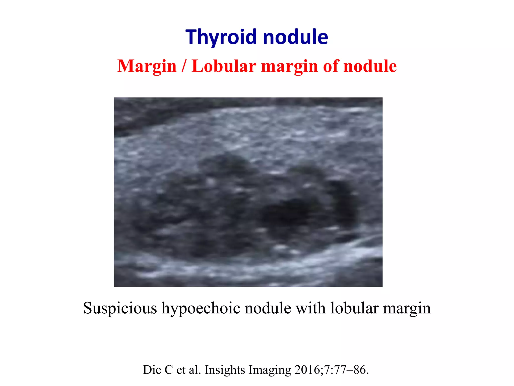 Ultrasound of thyroid nodules | PPTX
