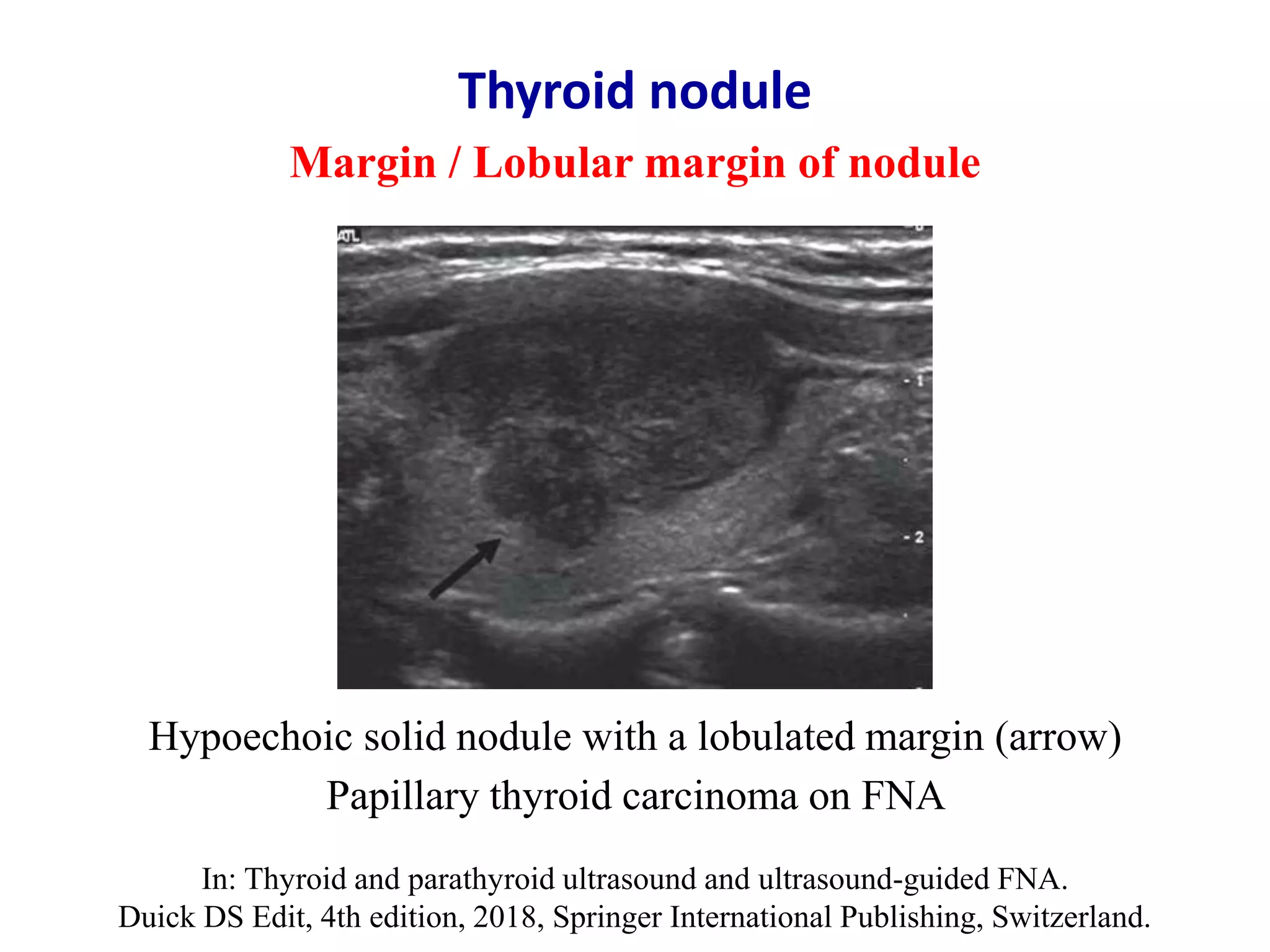 Ultrasound of thyroid nodules | PPTX