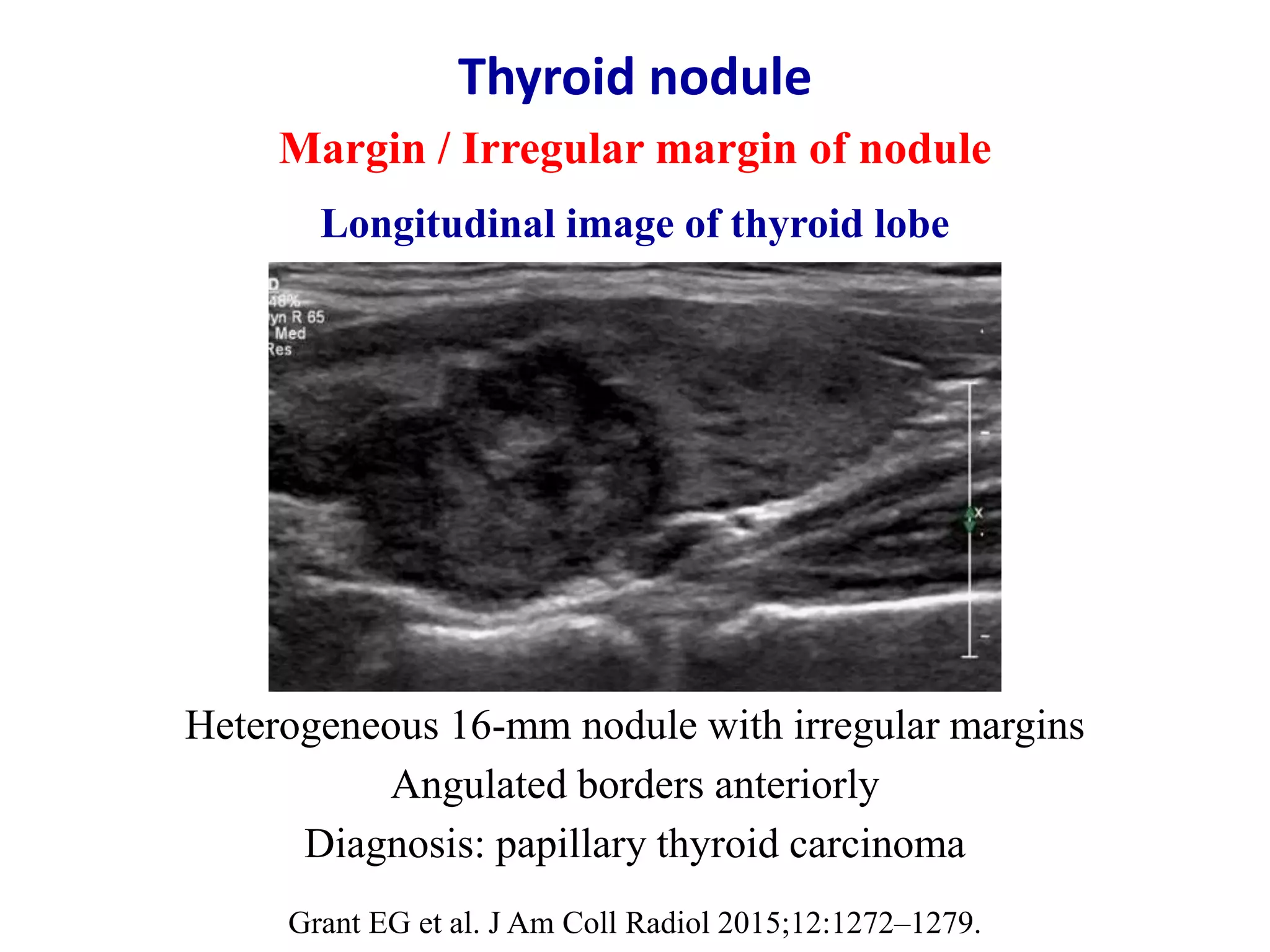 Ultrasound of thyroid nodules | PPTX