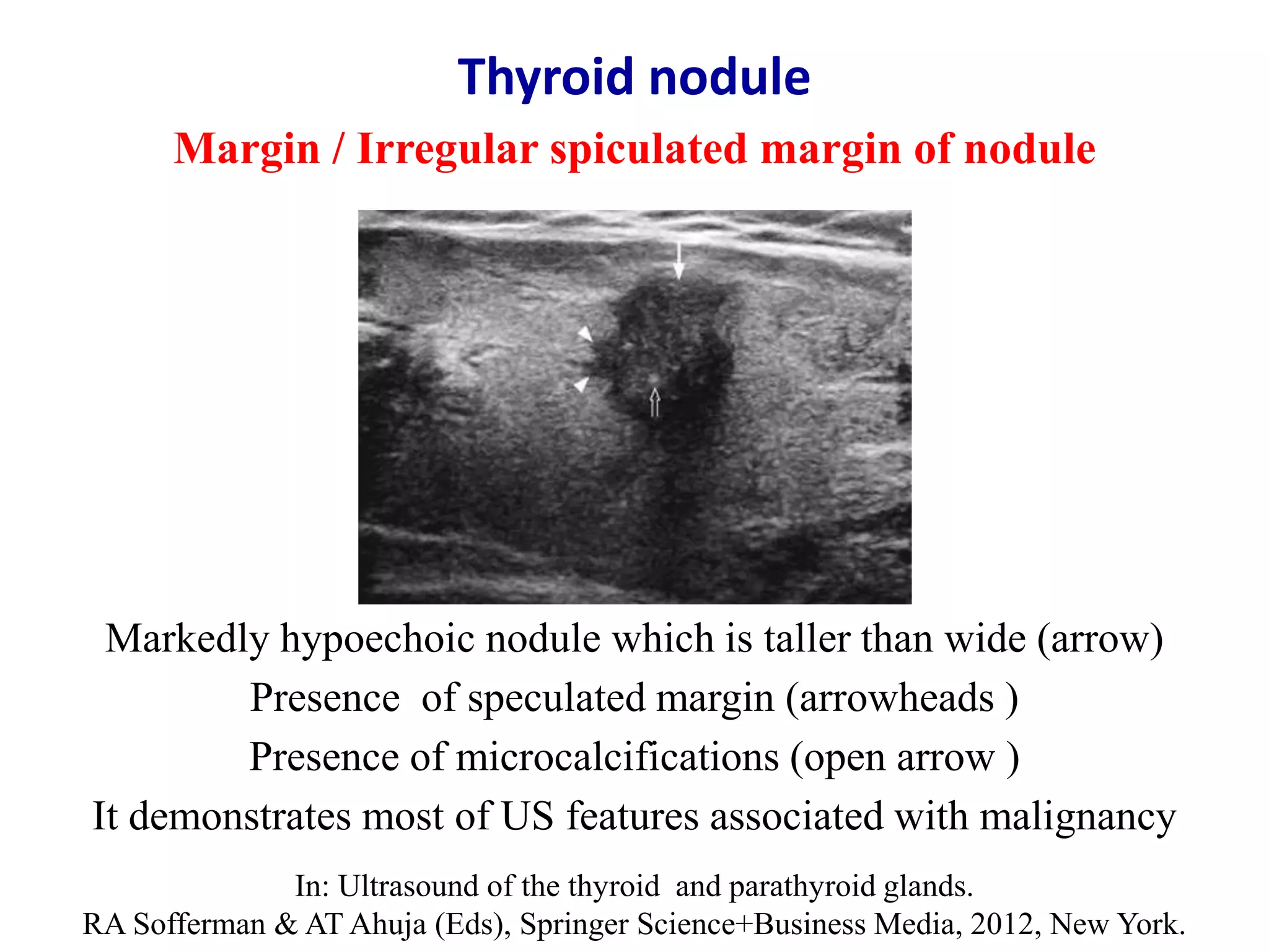 Ultrasound of thyroid nodules | PPTX