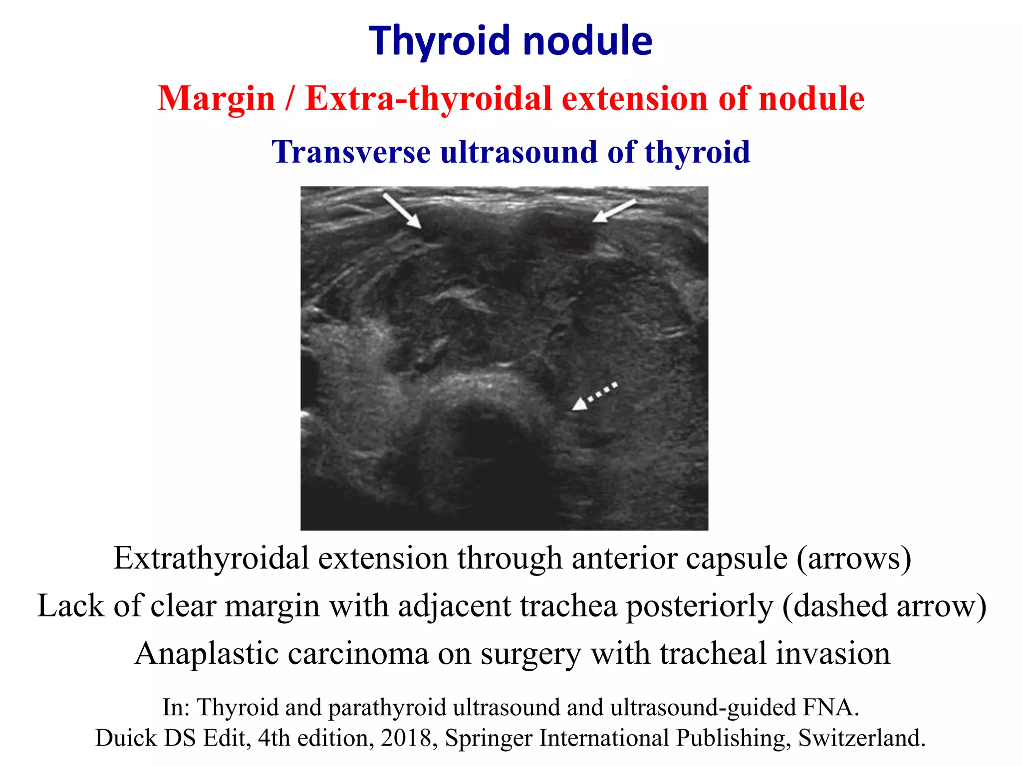 Ultrasound of thyroid nodules | PPTX