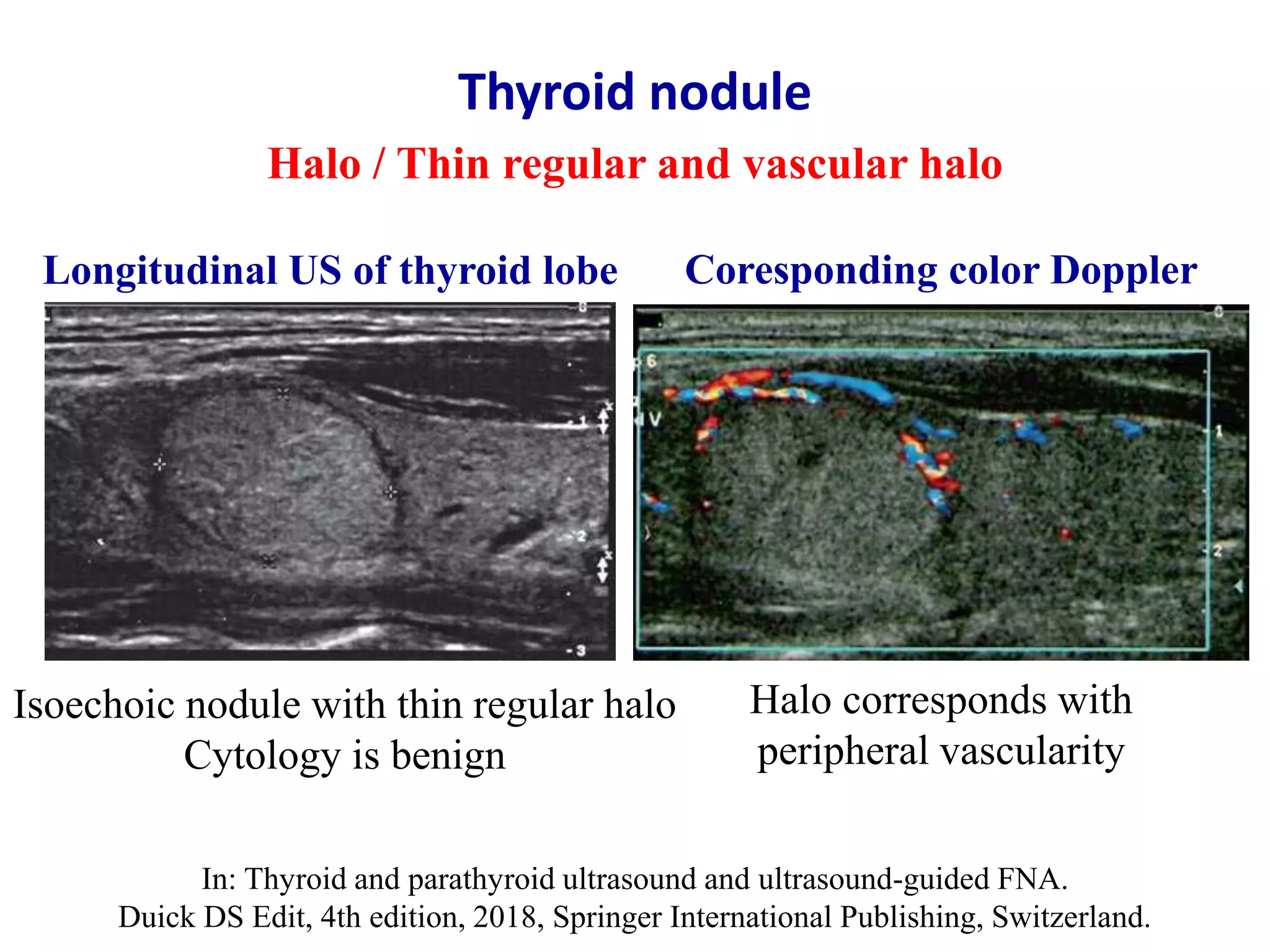 Ultrasound of thyroid nodules | PPTX