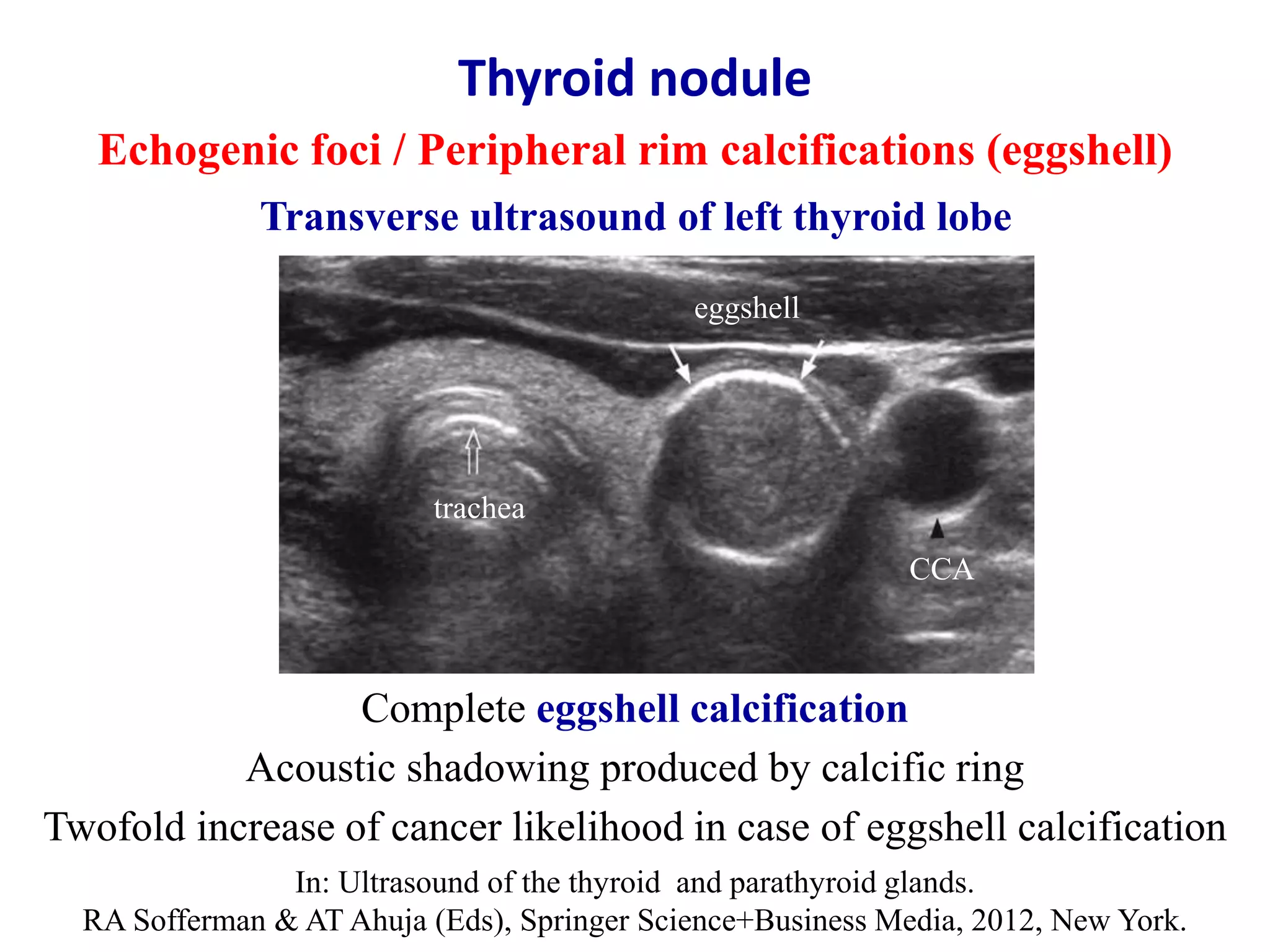 Ultrasound of thyroid nodules | PPTX