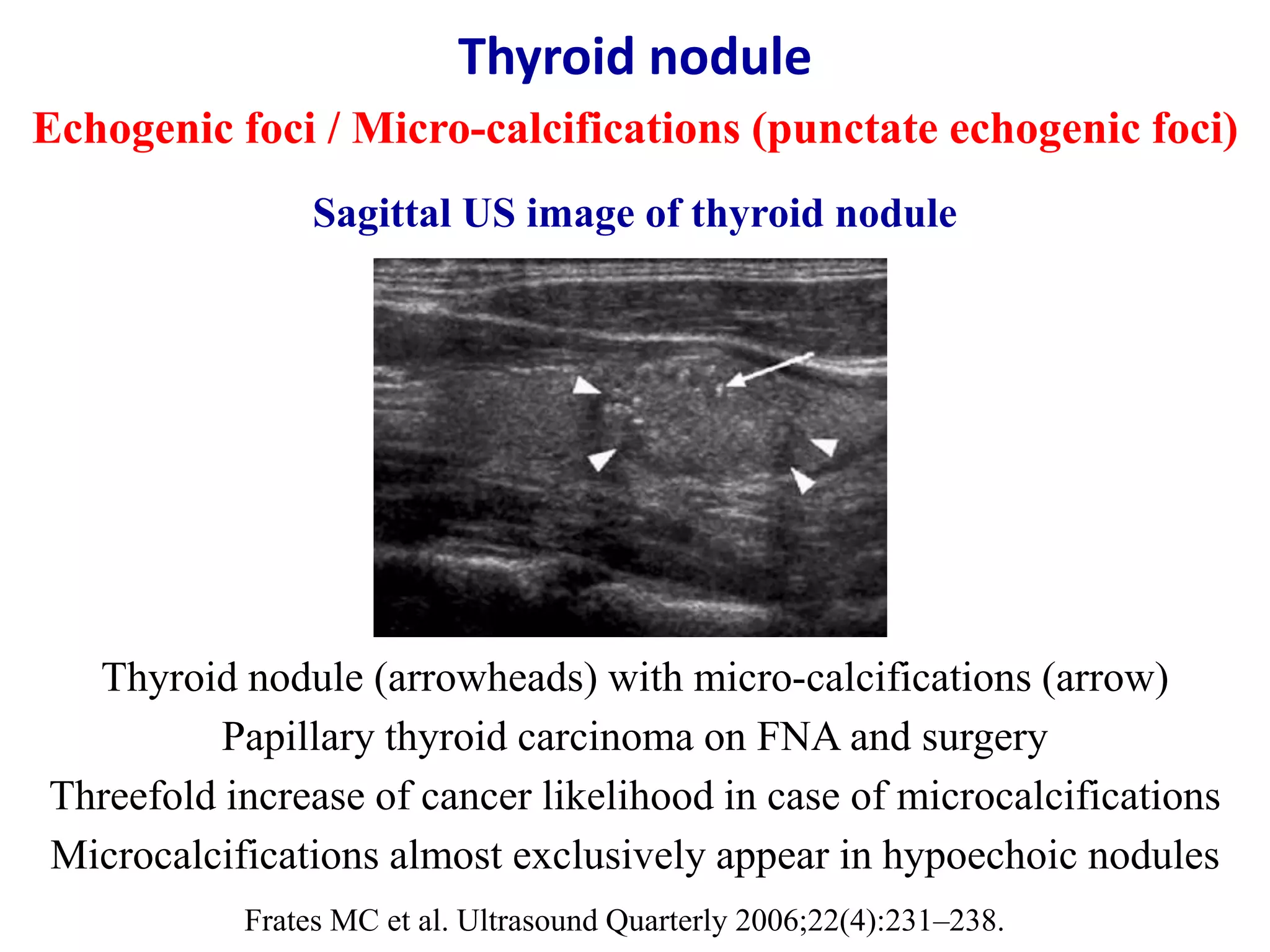 Ultrasound of thyroid nodules | PPTX