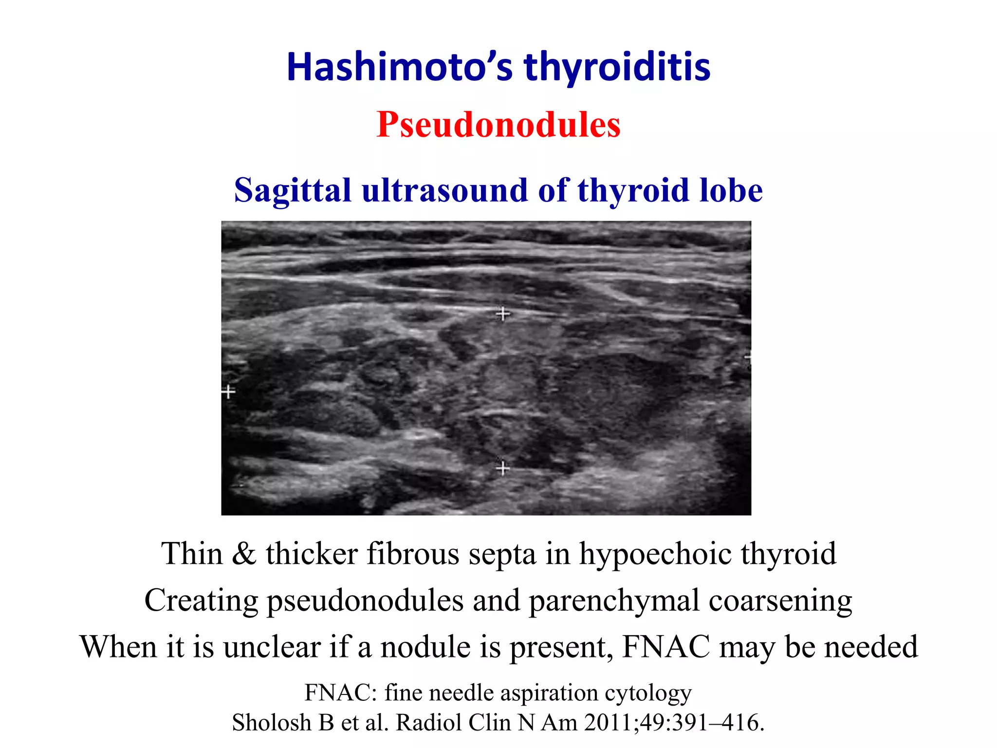 Ultrasound of thyroid nodules | PPTX
