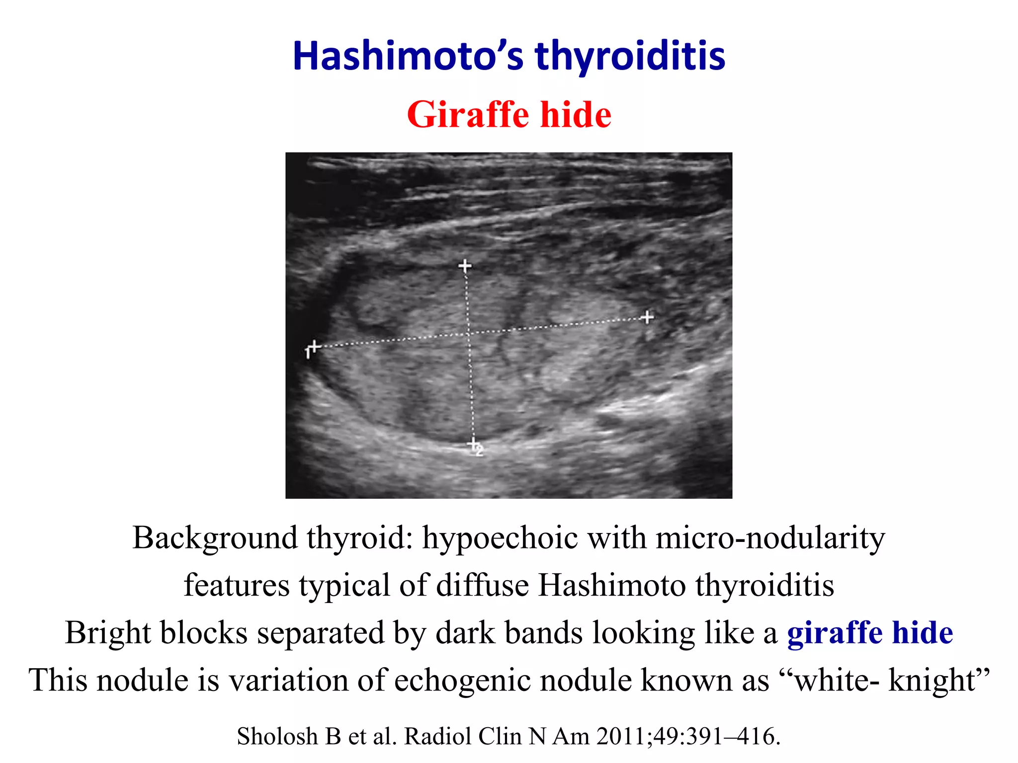 Ultrasound of thyroid nodules | PPTX