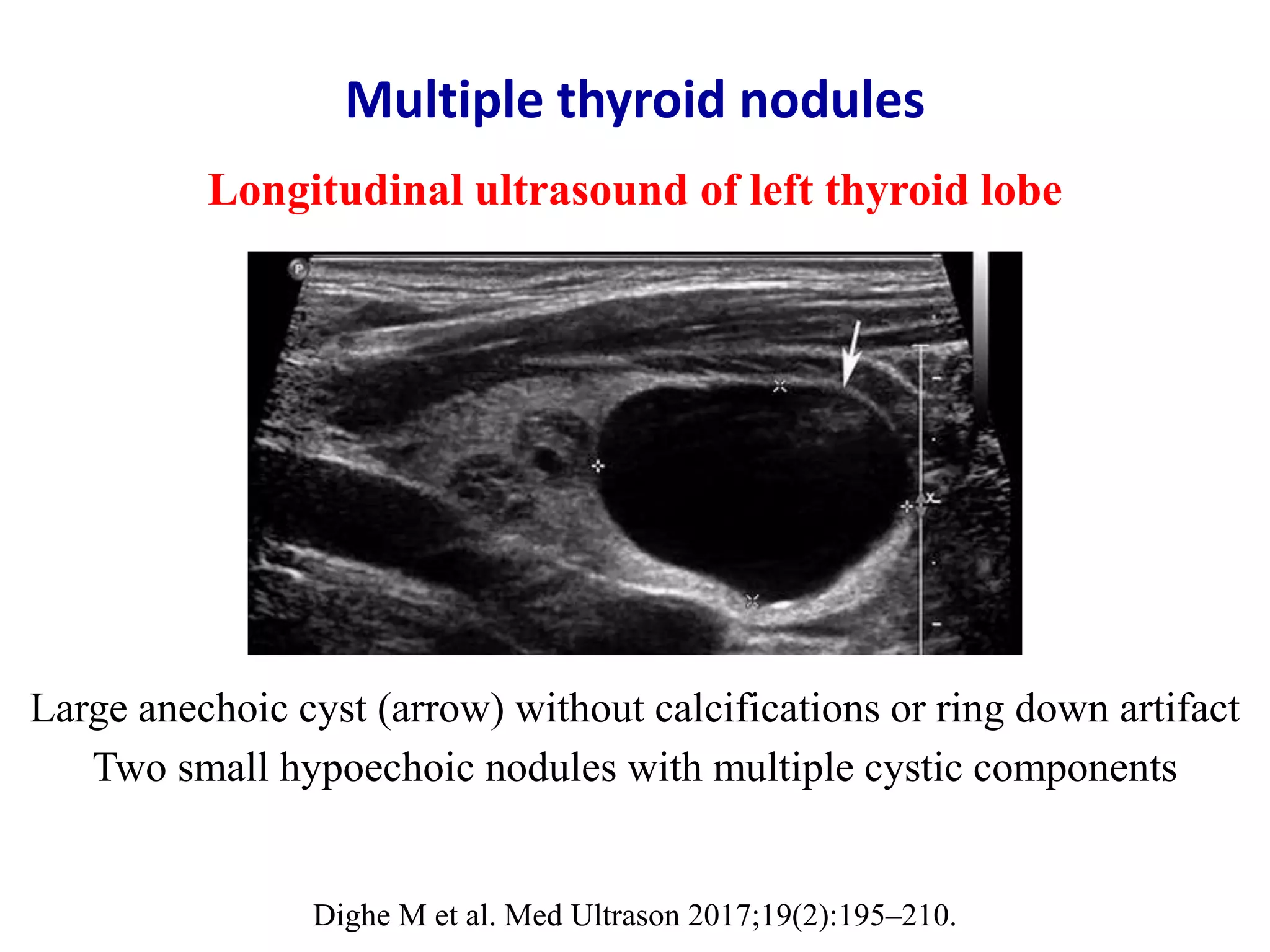 Ultrasound of thyroid nodules | PPTX