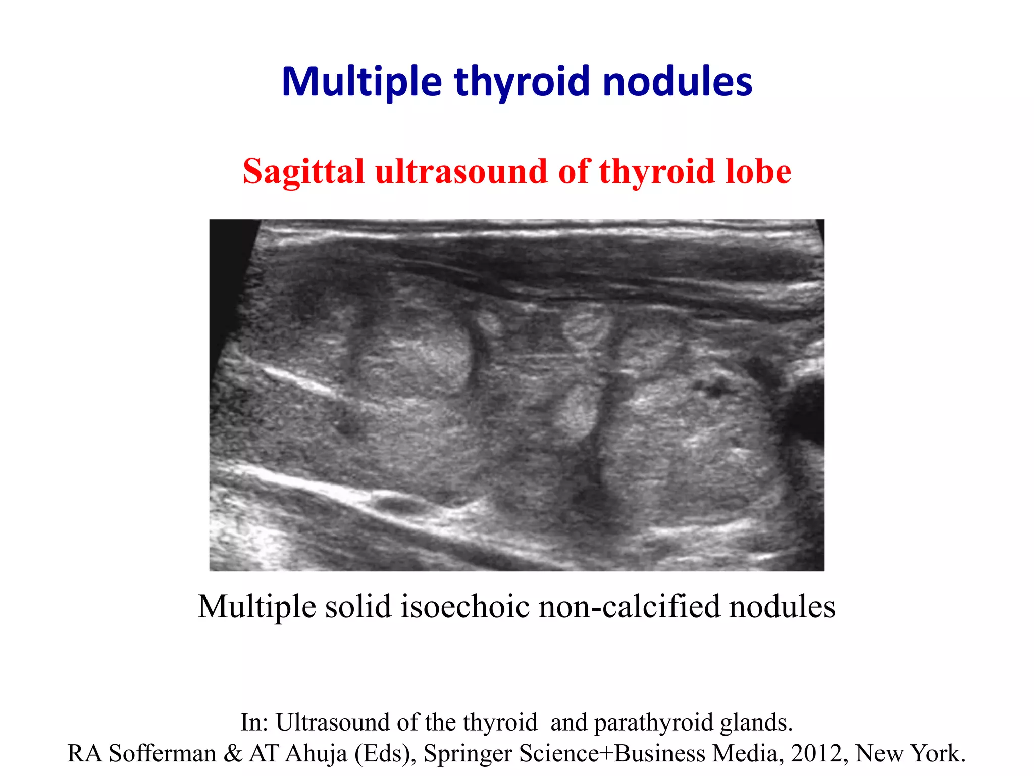 Ultrasound of thyroid nodules | PPTX