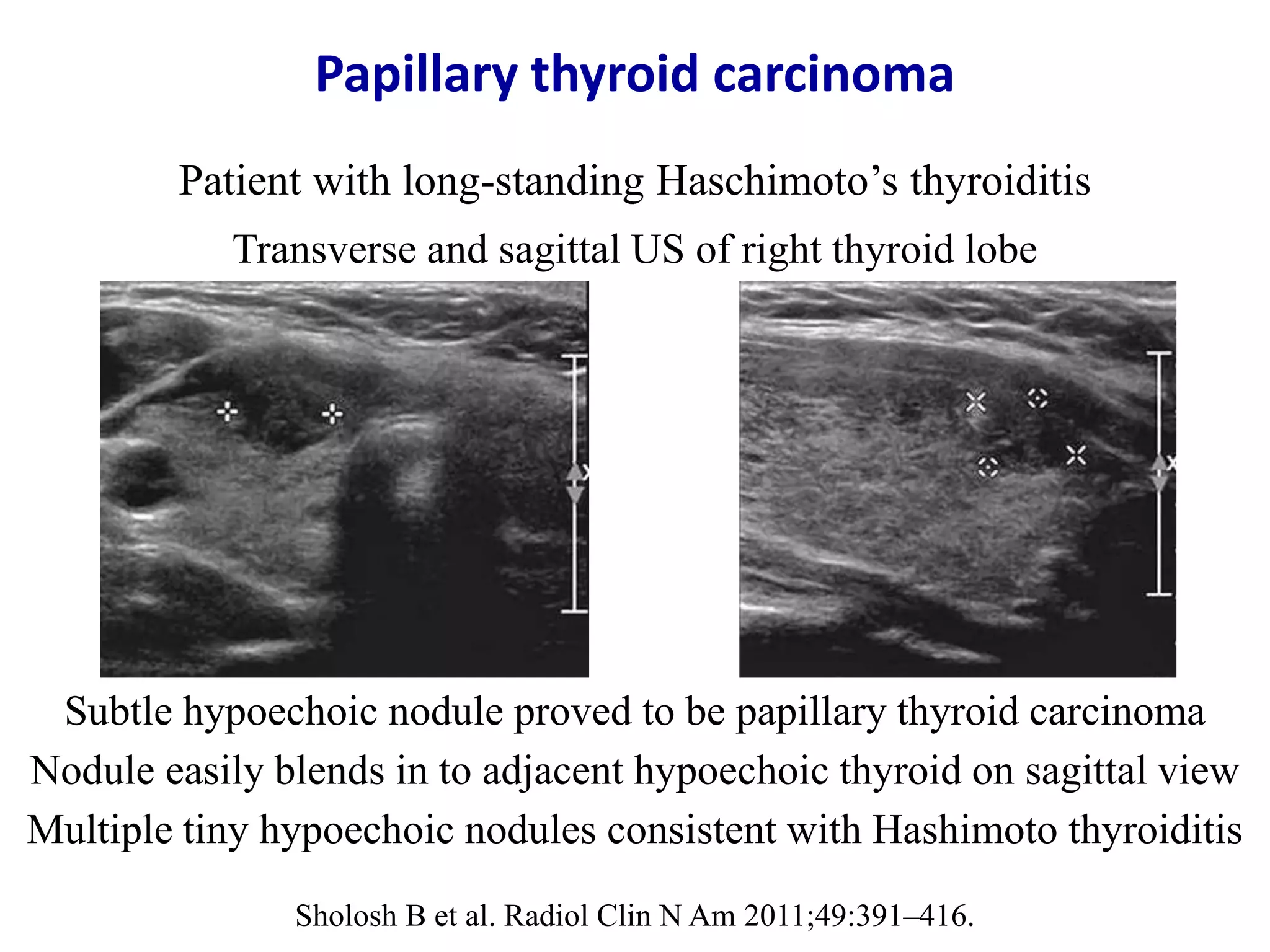 Ultrasound of thyroid nodules | PPTX