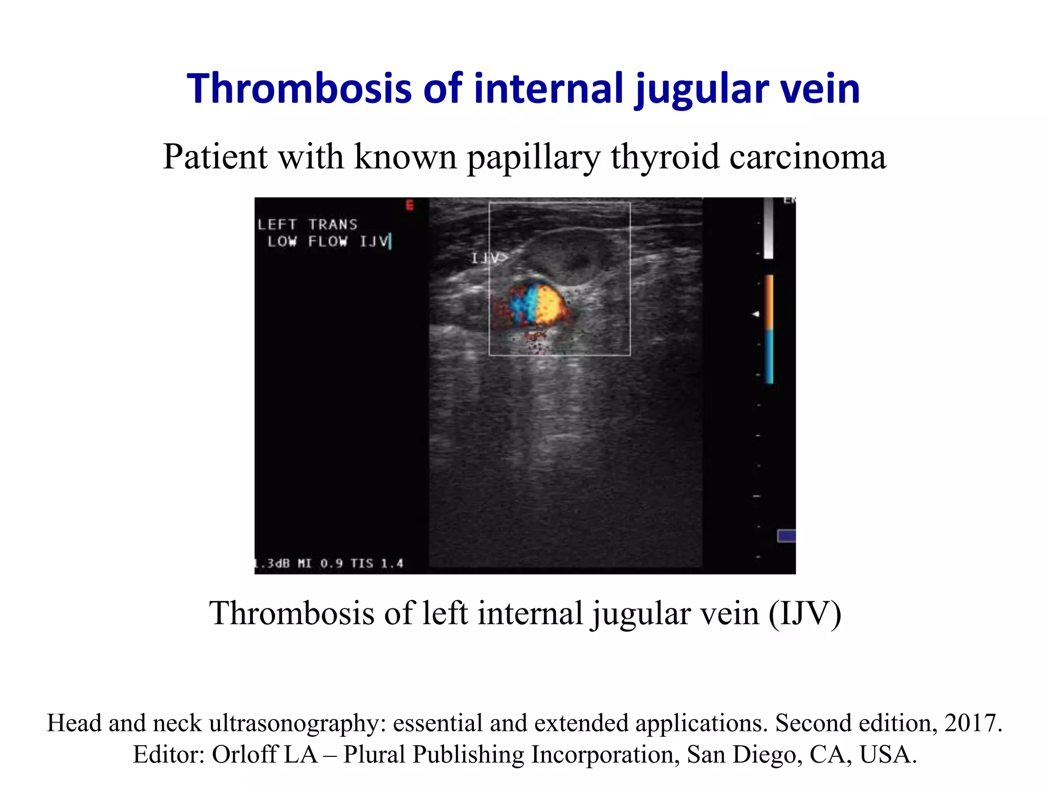 Ultrasound Of Thyroid Nodules Pptx