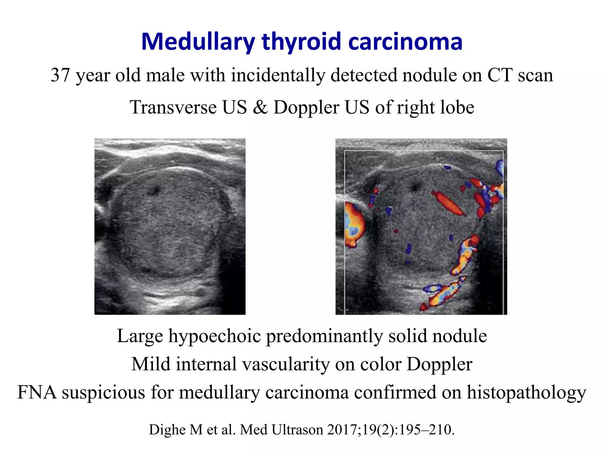 Ultrasound of thyroid nodules | PPTX