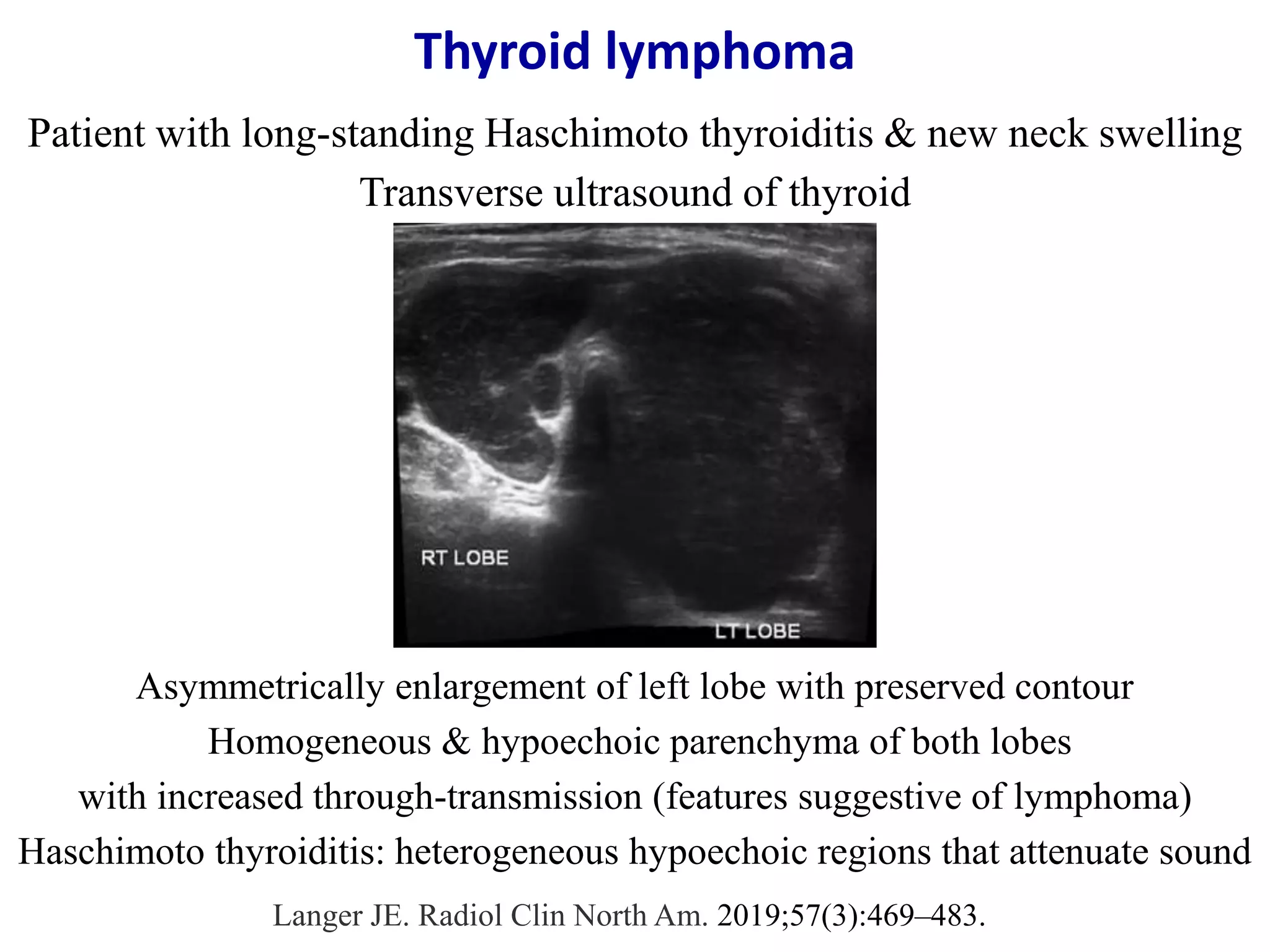 Ultrasound of thyroid nodules | PPTX