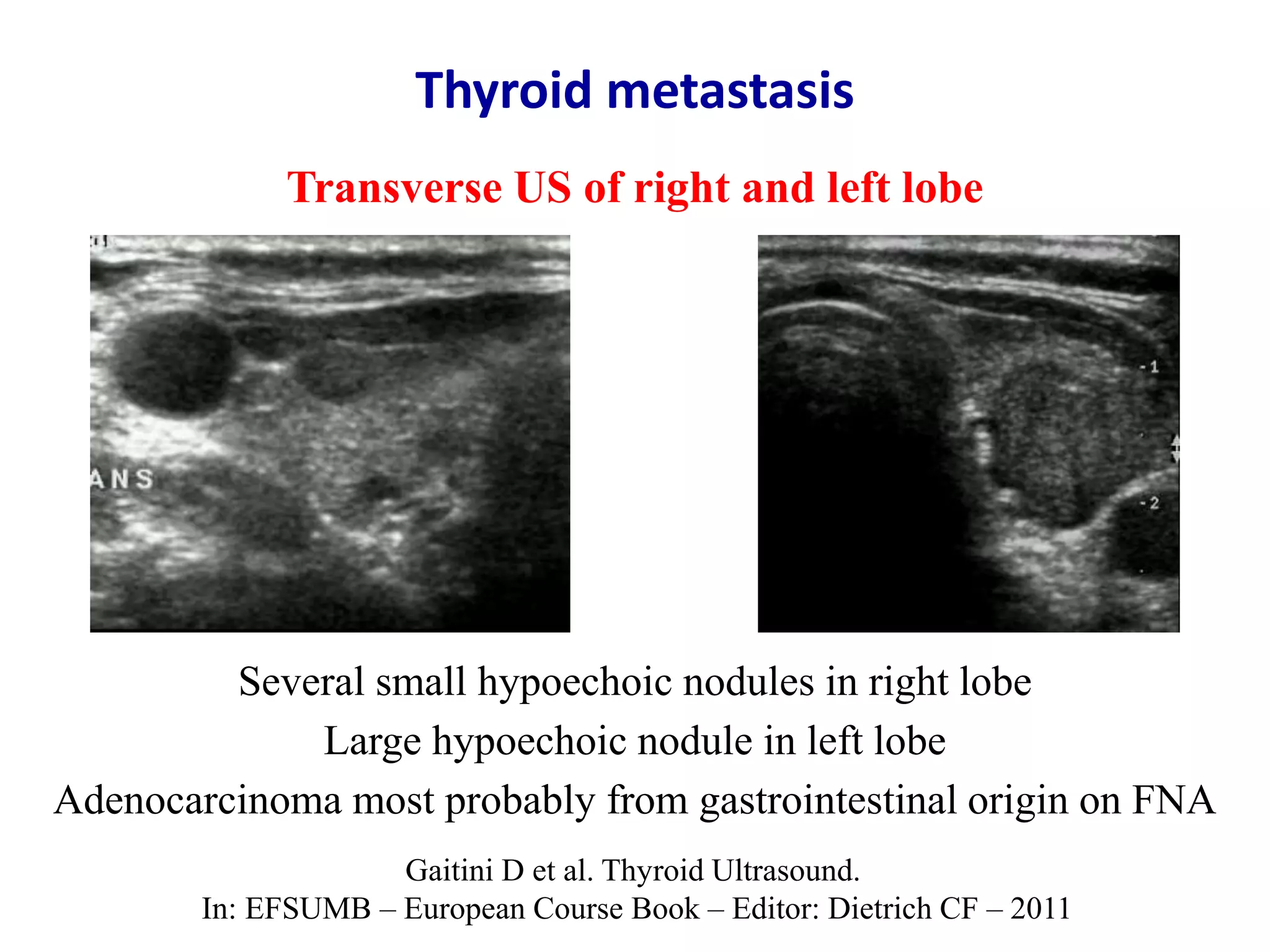 Ultrasound of thyroid nodules | PPTX