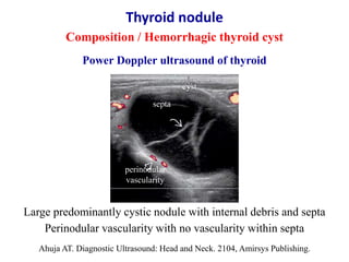Ultrasound of thyroid nodules | PPTX