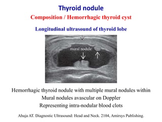 Ultrasound of thyroid nodules | PPTX