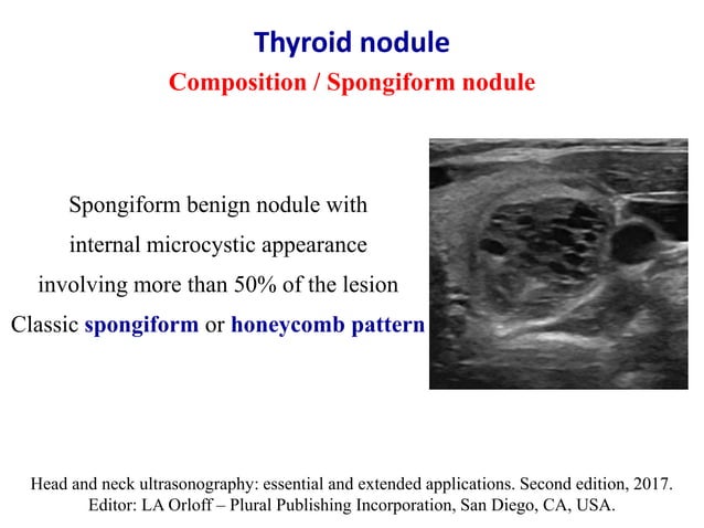 Ultrasound of thyroid nodules | PPTX | Thyroid Disorders | Endocrine ...