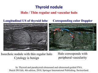 Ultrasound of thyroid nodules | PPTX