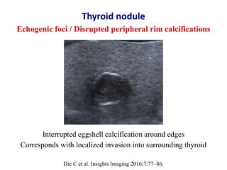 Ultrasound of thyroid nodules | PPTX