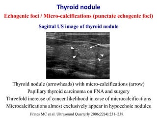 Ultrasound of thyroid nodules | PPTX