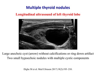 Ultrasound of thyroid nodules | PPTX