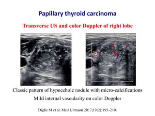 Ultrasound of thyroid nodules | PPTX