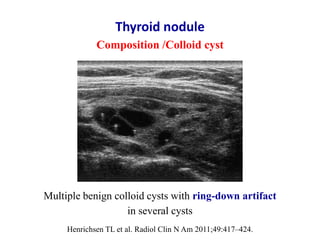 Ultrasound of thyroid nodules | PPT