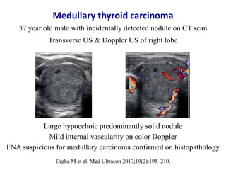 Ultrasound of thyroid nodules | PPT