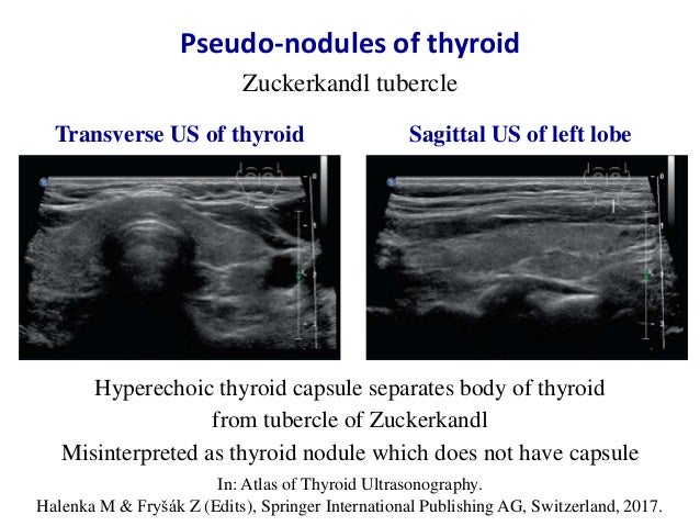 Ultrasound of thyroid nodules
