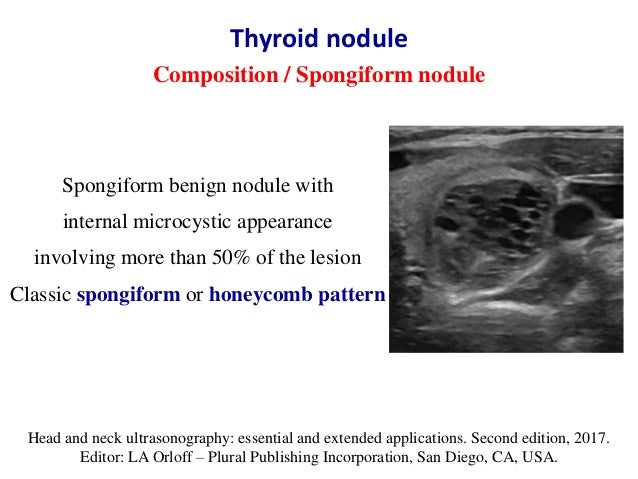 Ultrasound of thyroid nodules