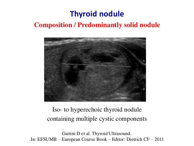 Ultrasound of thyroid nodules
