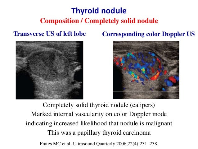 Ultrasound of thyroid nodules