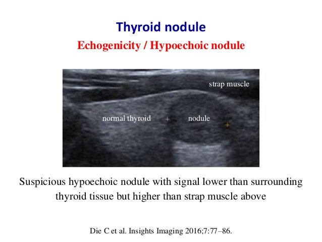 Ultrasound of thyroid nodules