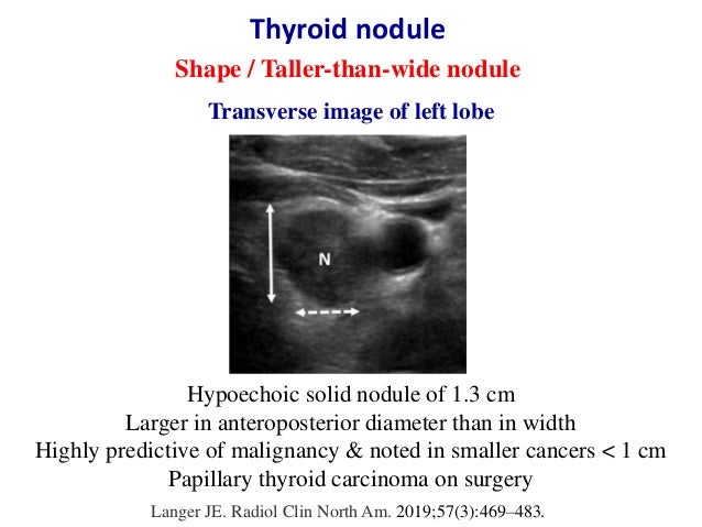 Ultrasound of thyroid nodules