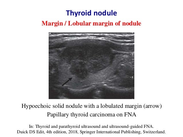 Ultrasound of thyroid nodules