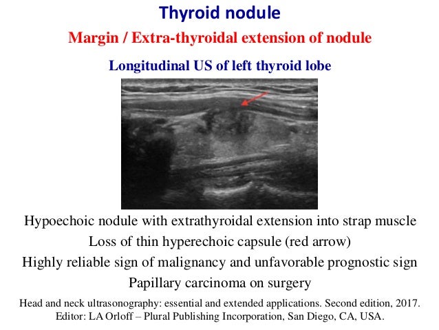 Ultrasound of thyroid nodules