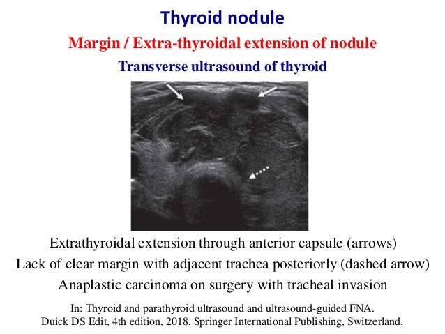 Ultrasound of thyroid nodules