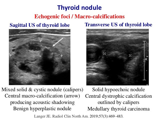 Ultrasound Of Thyroid Nodules