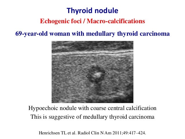 Ultrasound of thyroid nodules